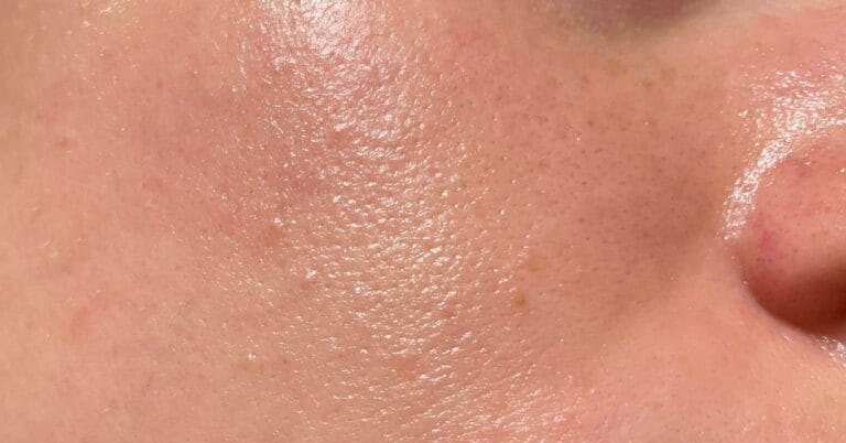 What Are the Best Ingredients for Oily Skin? | Pureance